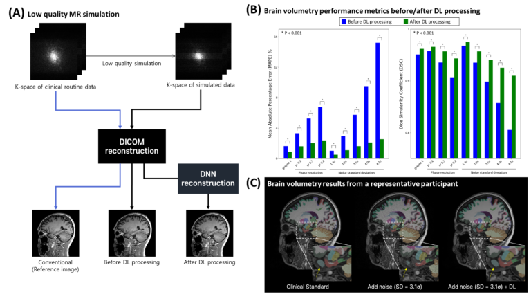 Deep Learning Based Mr Reconstruction Improves Robustness Of Brain Volumetry In Low Quality Mr
